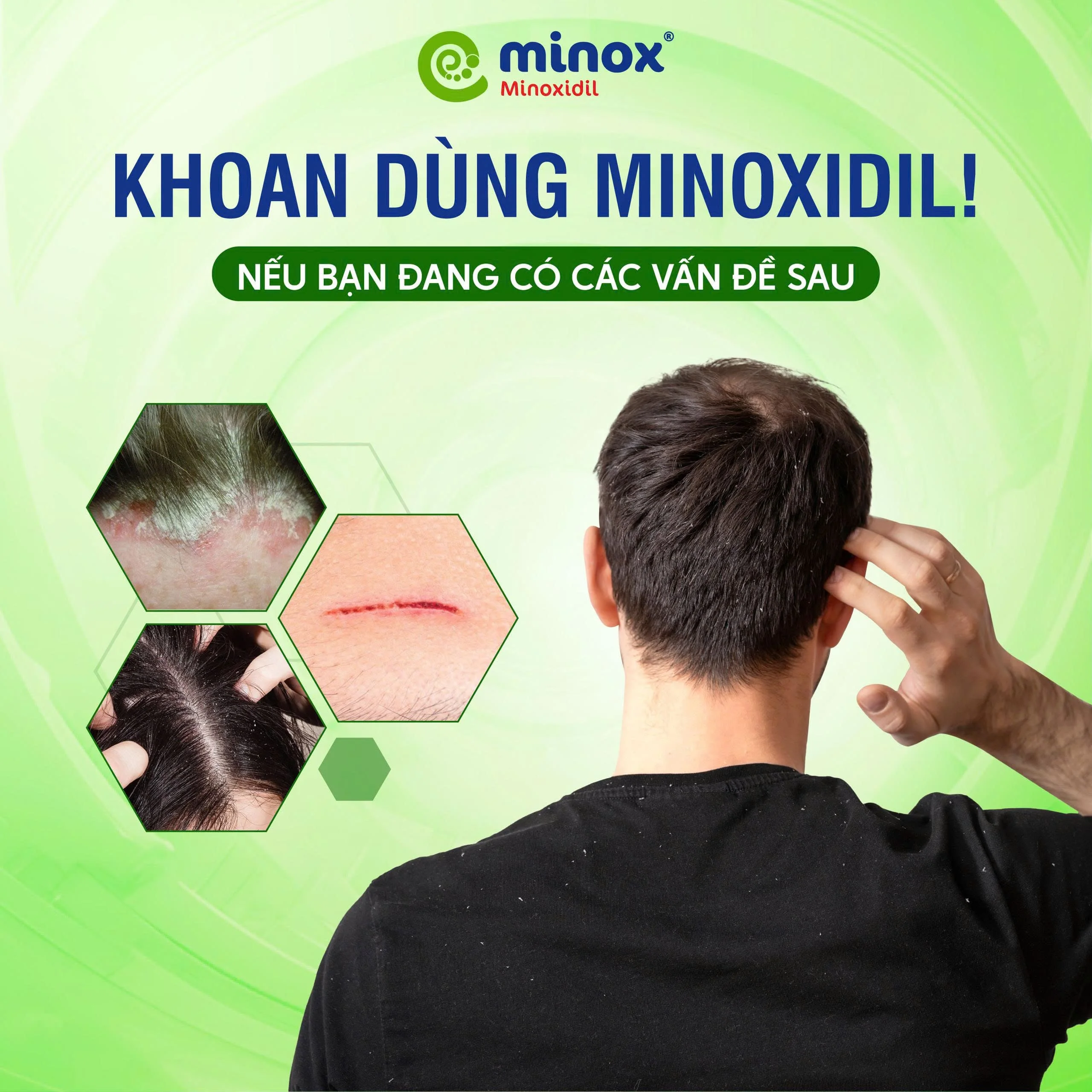 Ngưng dùng Minoxidil có bị rụng tóc lại không? Cách xử lý hiệu quả - Minox